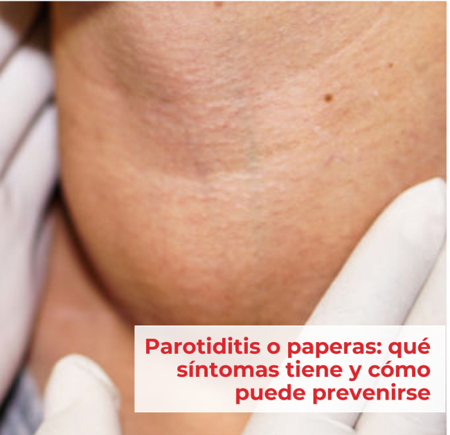 Paperas Archives | Clínica San Miguel | Cuidamos Tu Salud